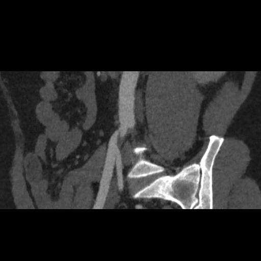 CT Scanner SOMATOM Scope