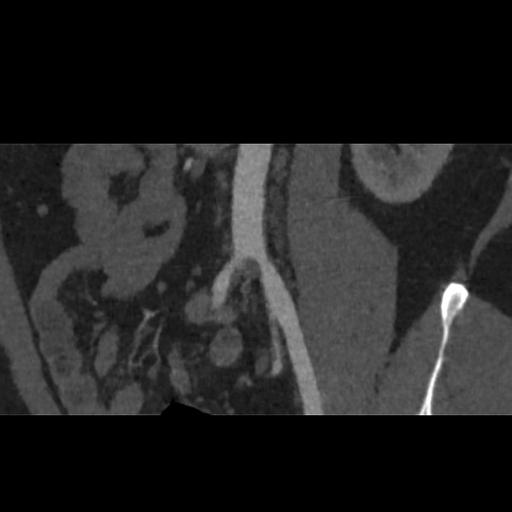CT Scanner SOMATOM Scope