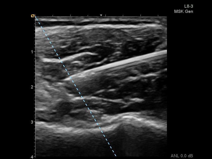 Wireless Ultrasound Transducers | ACUSON Freestyle