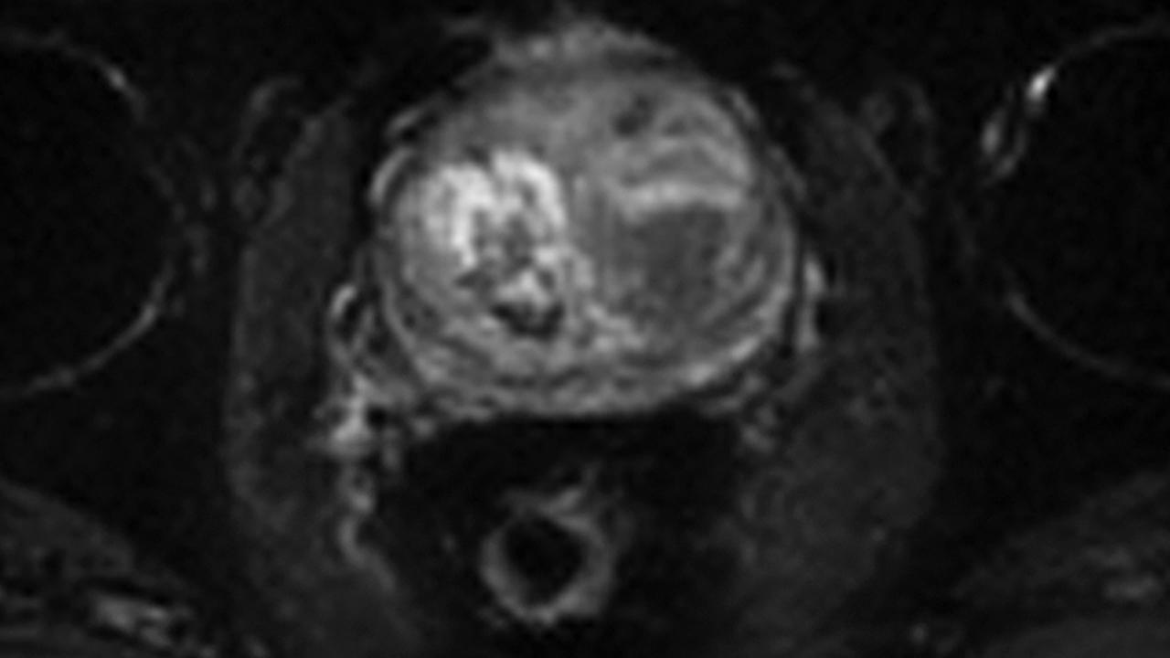 Prostate MRI