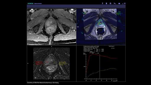 Prostate MRI