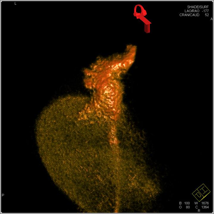 syngo DynaCT Cardiac