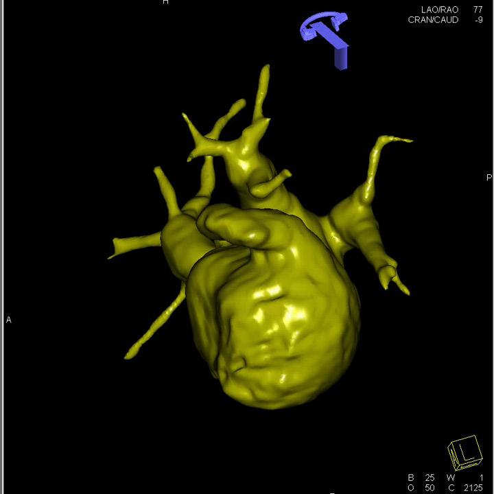 syngo DynaCT Cardiac