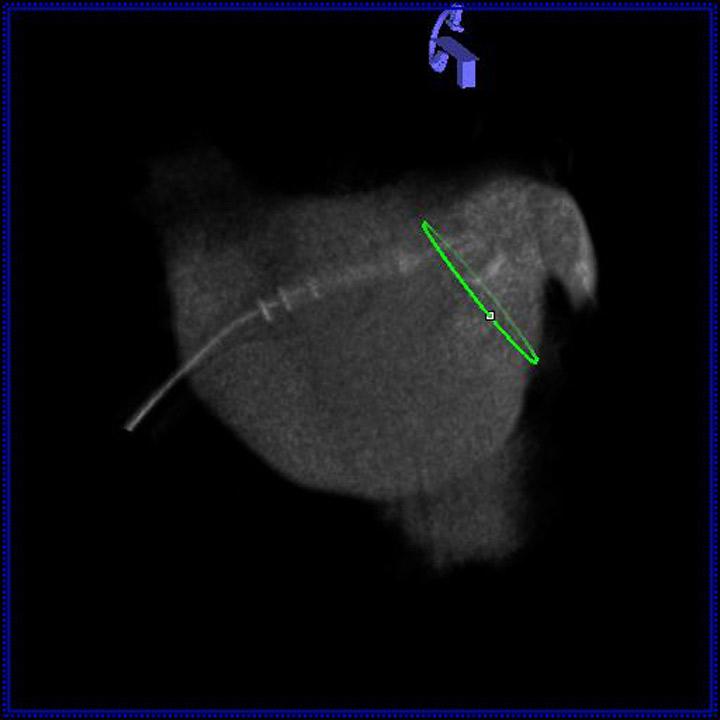 syngo DynaCT Cardiac