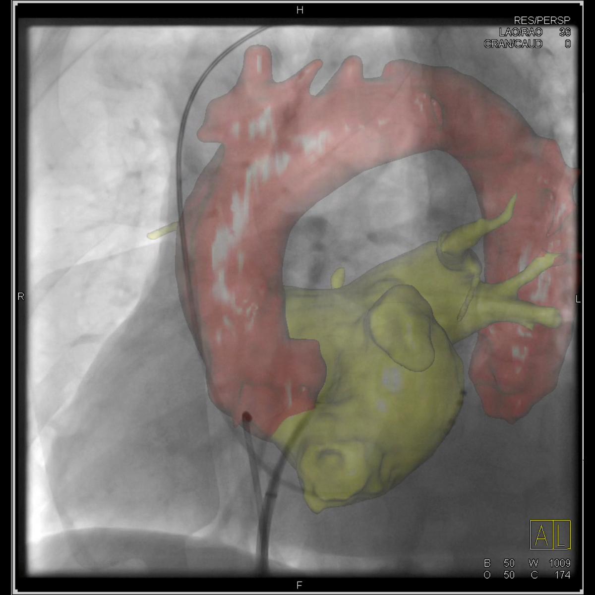 syngo DynaCT Cardiac
