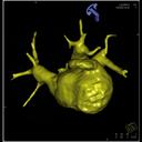 syngo DynaCT Cardiac