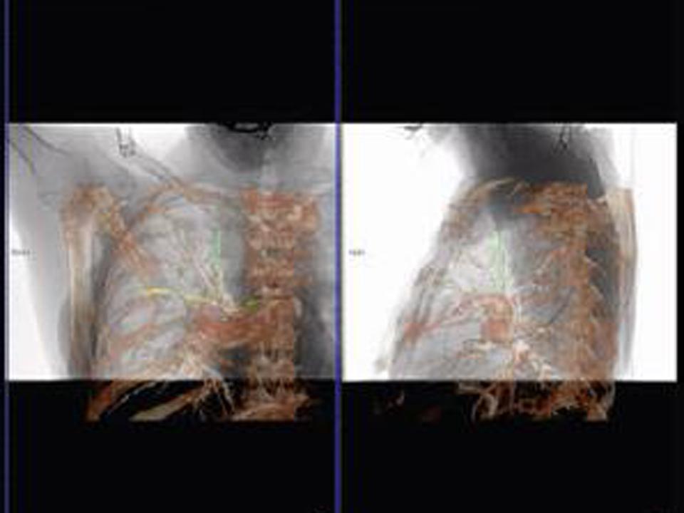 Peripheral and Vascular Interventions