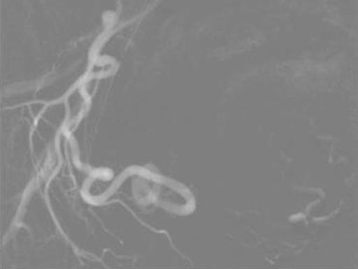 Peripheral and Vascular Interventions