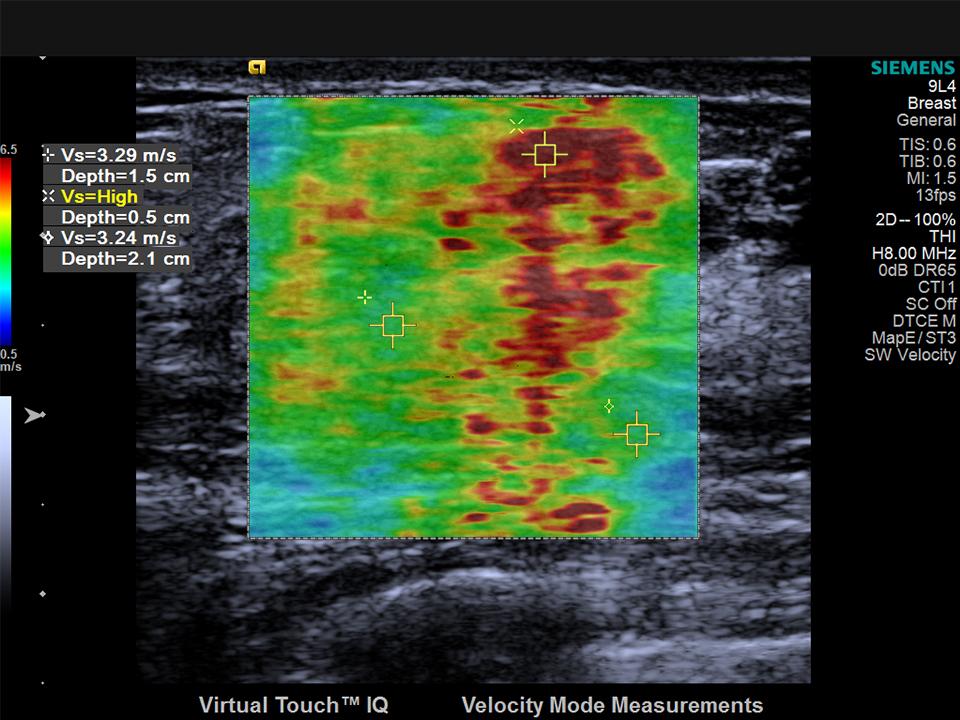 Elastografia por Ultrassom