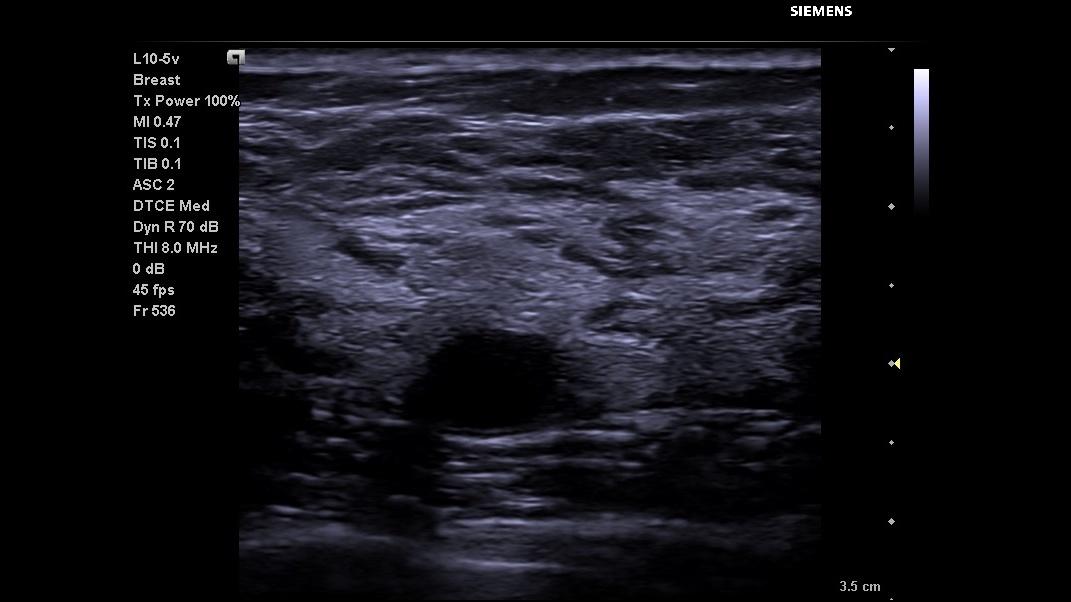 ACUSON P500 Ultrasound System