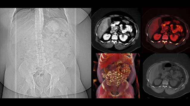 What is Dual Source Dual Energy?