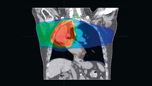 Getting to the Point in Radiotherapy