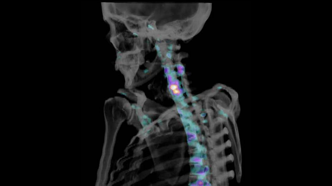 Loosening of tibial component of knee arthroplasty with medial ...