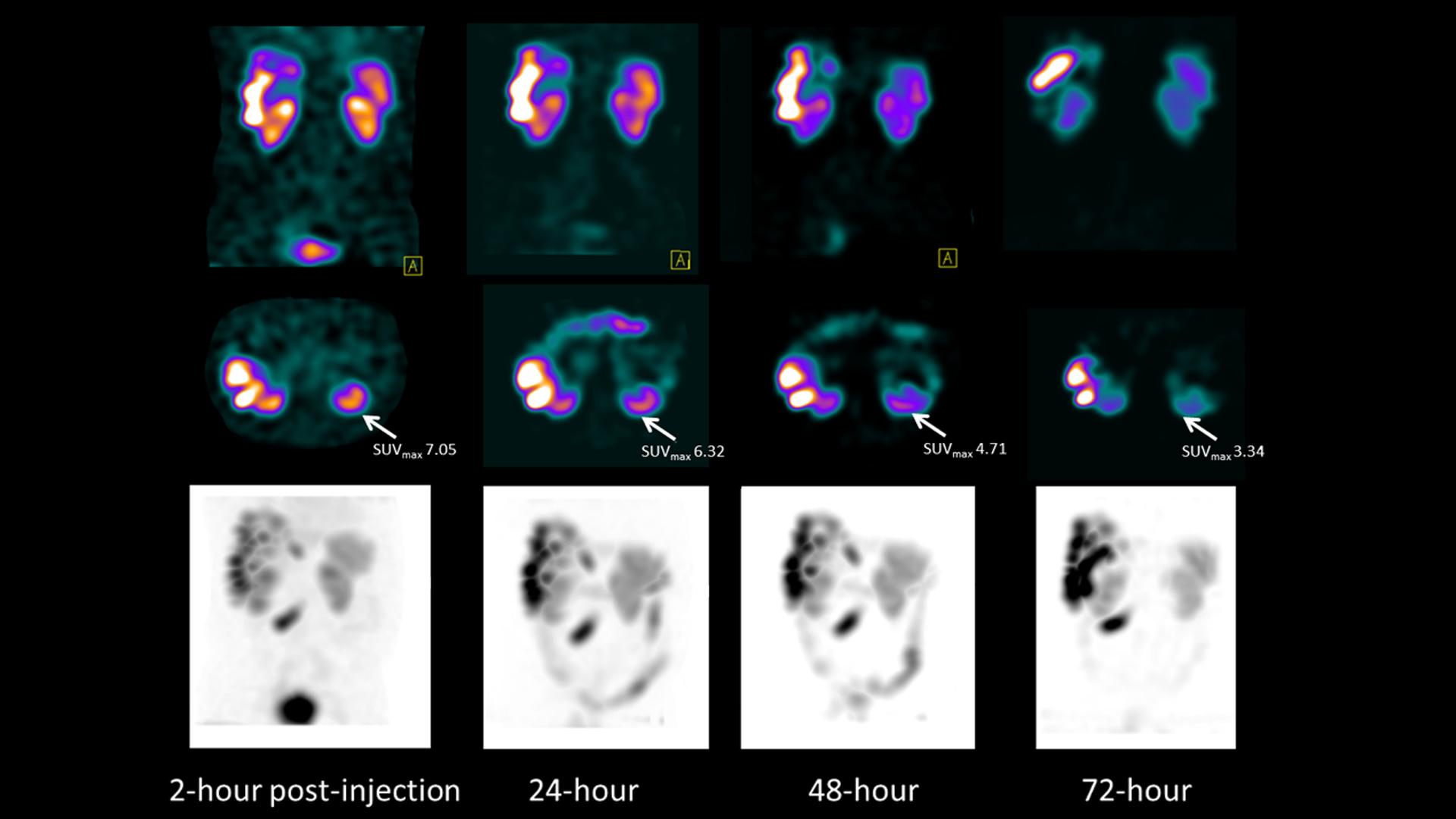 Sequential quantitative SPECT/CT following therapeutic administration of 177Lu DOTATATE in a ...