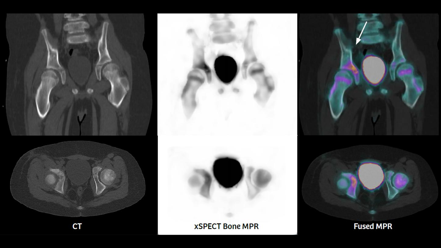Loosening of tibial component of knee arthroplasty with medial ...