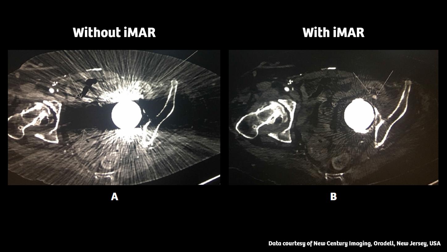 Prosthetic Metallic Artifact Reduction