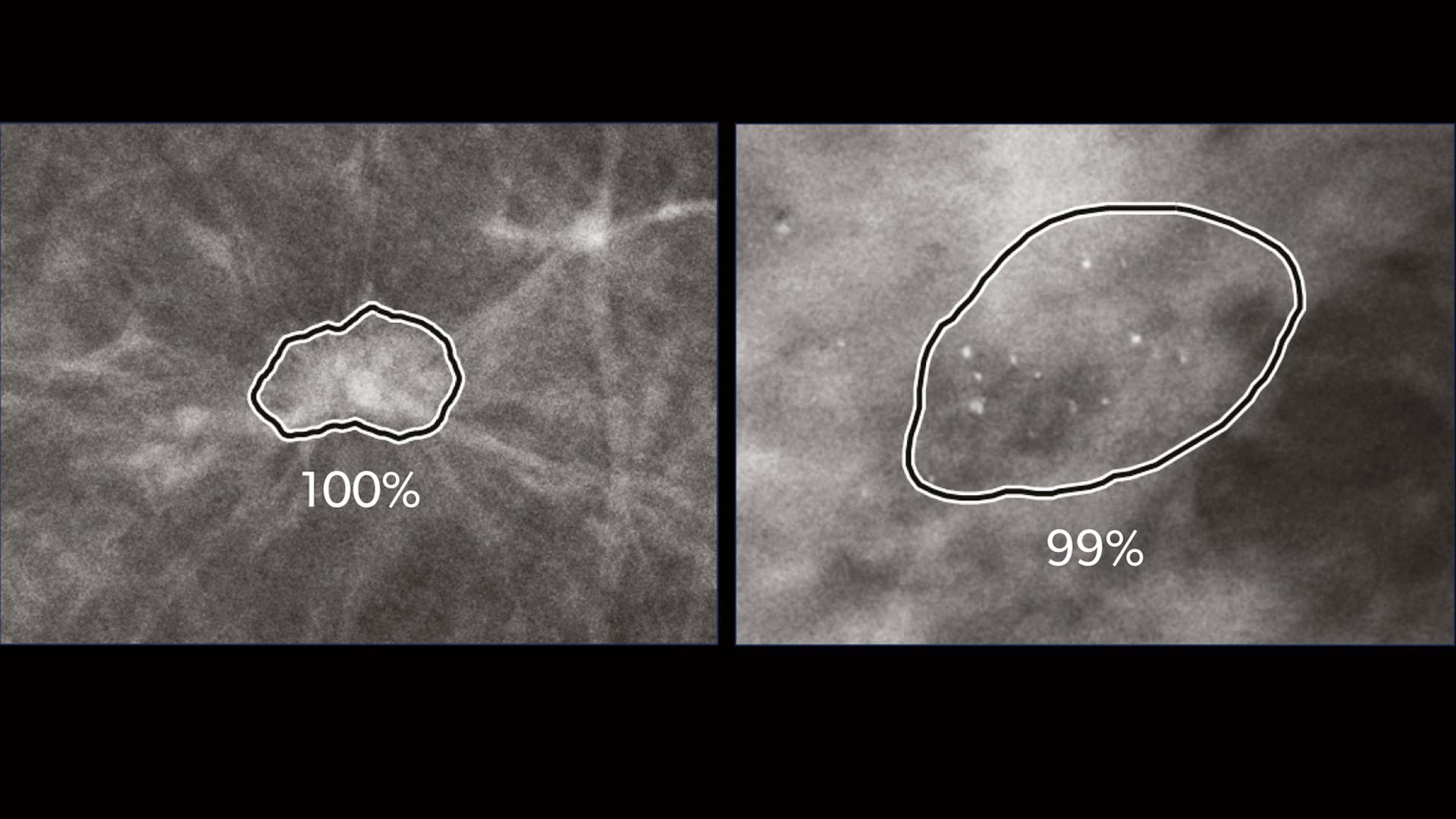 History of computer-aided detection (CAD)