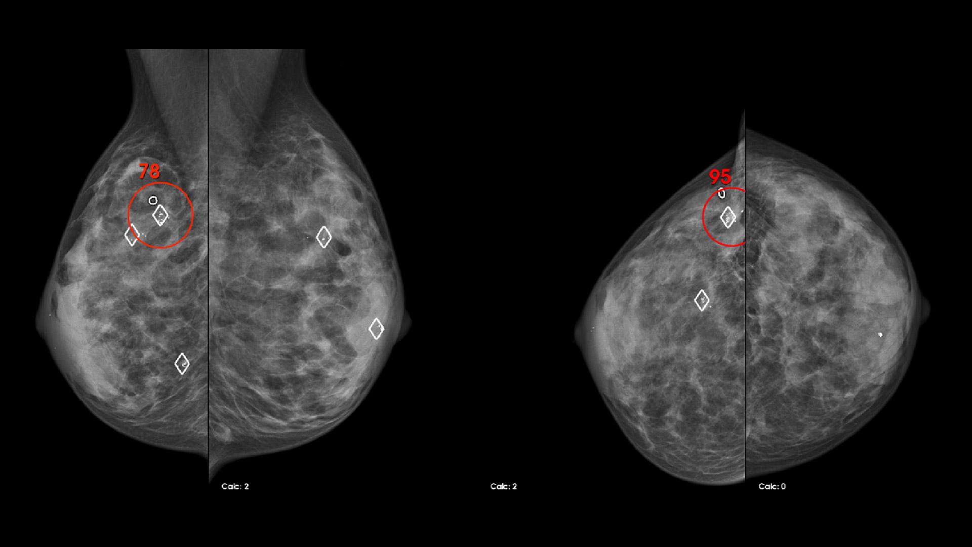 How CAD can help save time in mammography reading