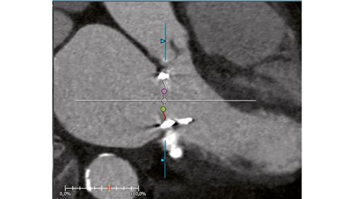 Valvular Heart Disease Treatment in Challenging Patients