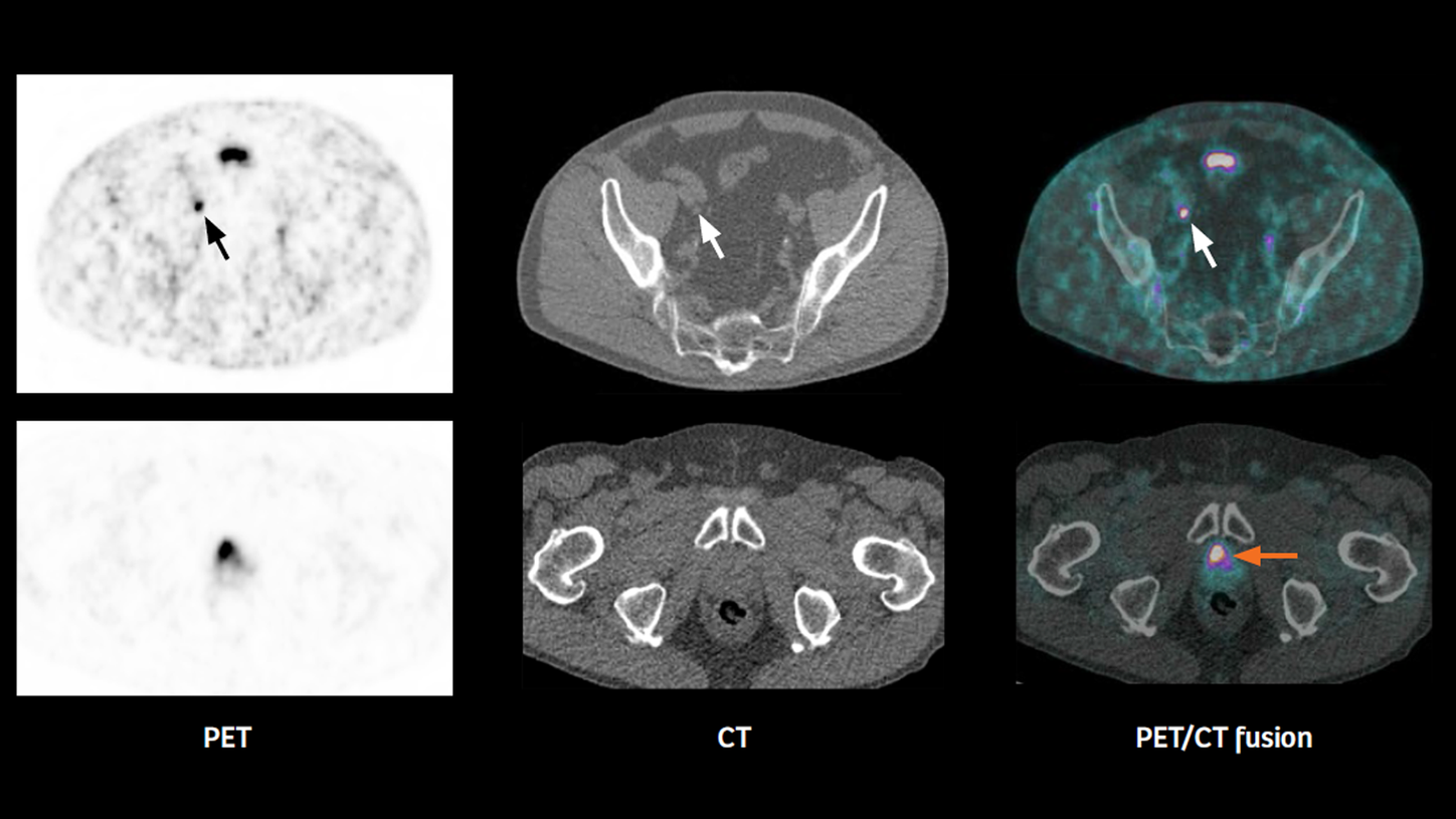Detection of Solitary Pelvic Lymph Node Metastasis in a Patient with ...