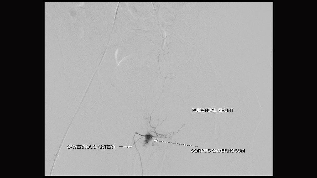 Prostatic Artery Embolization is Here to Stay