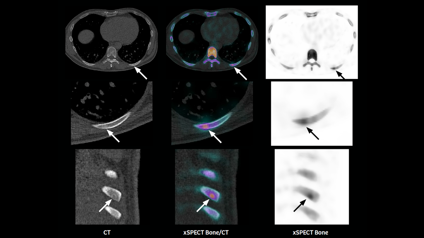 Differentiation of a rib benign lesion from a metastasis using xSPECT Quant