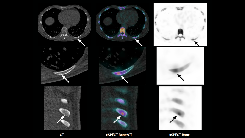 Differentiation of a rib benign lesion from a metastasis using xSPECT Quant