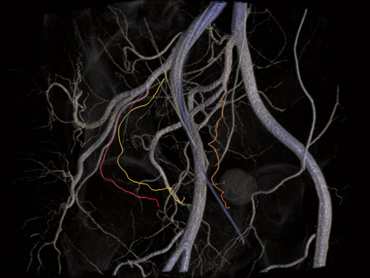 Interventional Radiology