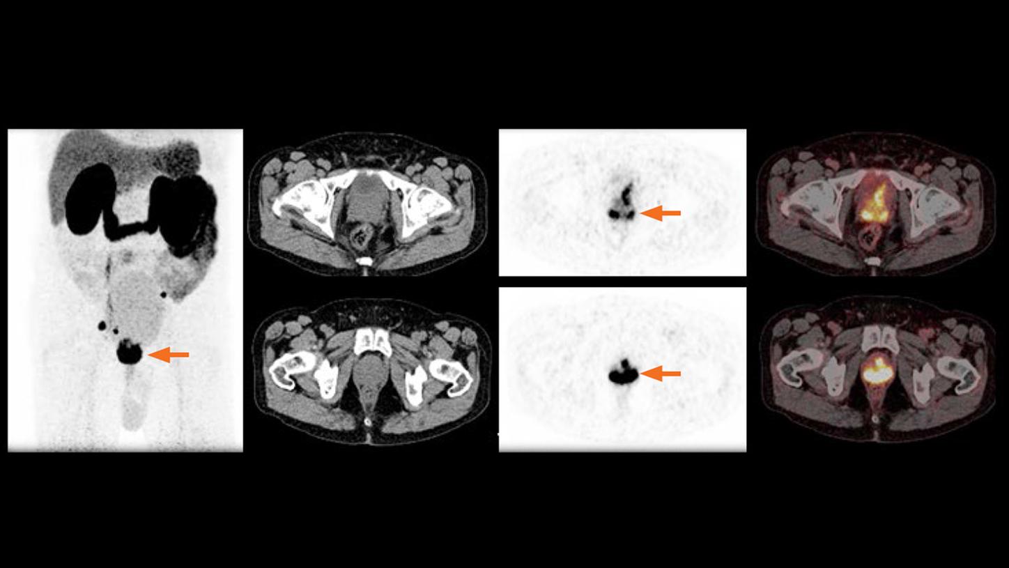Detection of bladder invasion and pelvic lymph node metastases in a ...