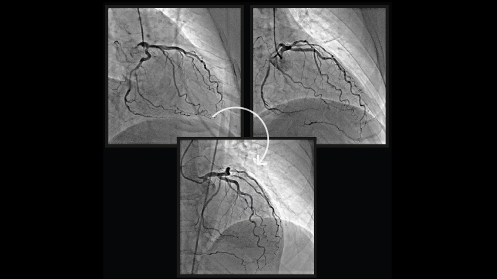 Angiography