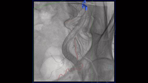 Training is Vital to Provide Effective PAE Treatment