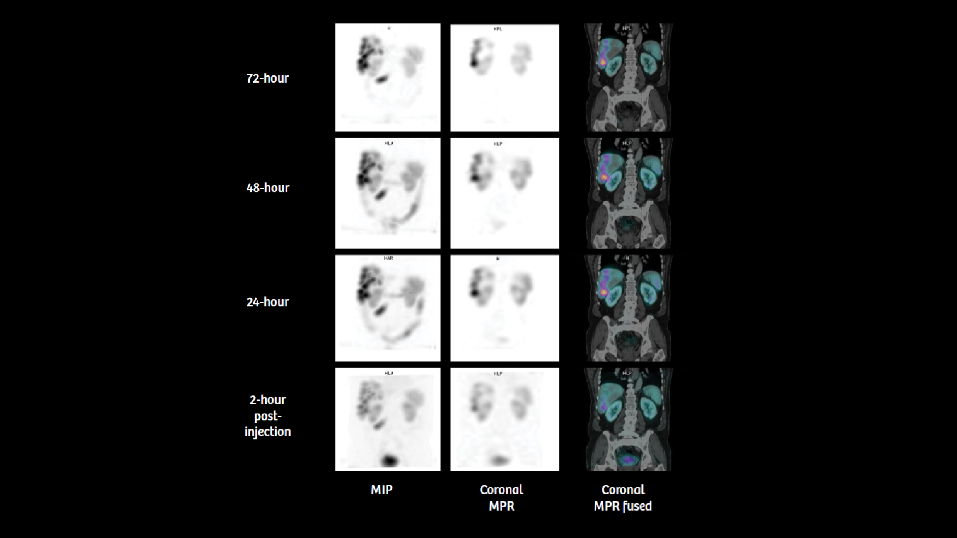 Sequential quantitative SPECT/CT following therapeutic administration of 177Lu DOTATATE in a ...
