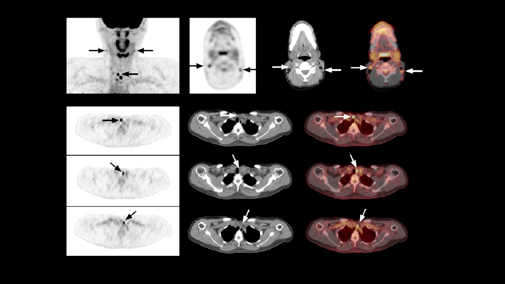 PET/CT detection of Fludeoxyglucose F 18 Injection (18F FDG)-avid ...