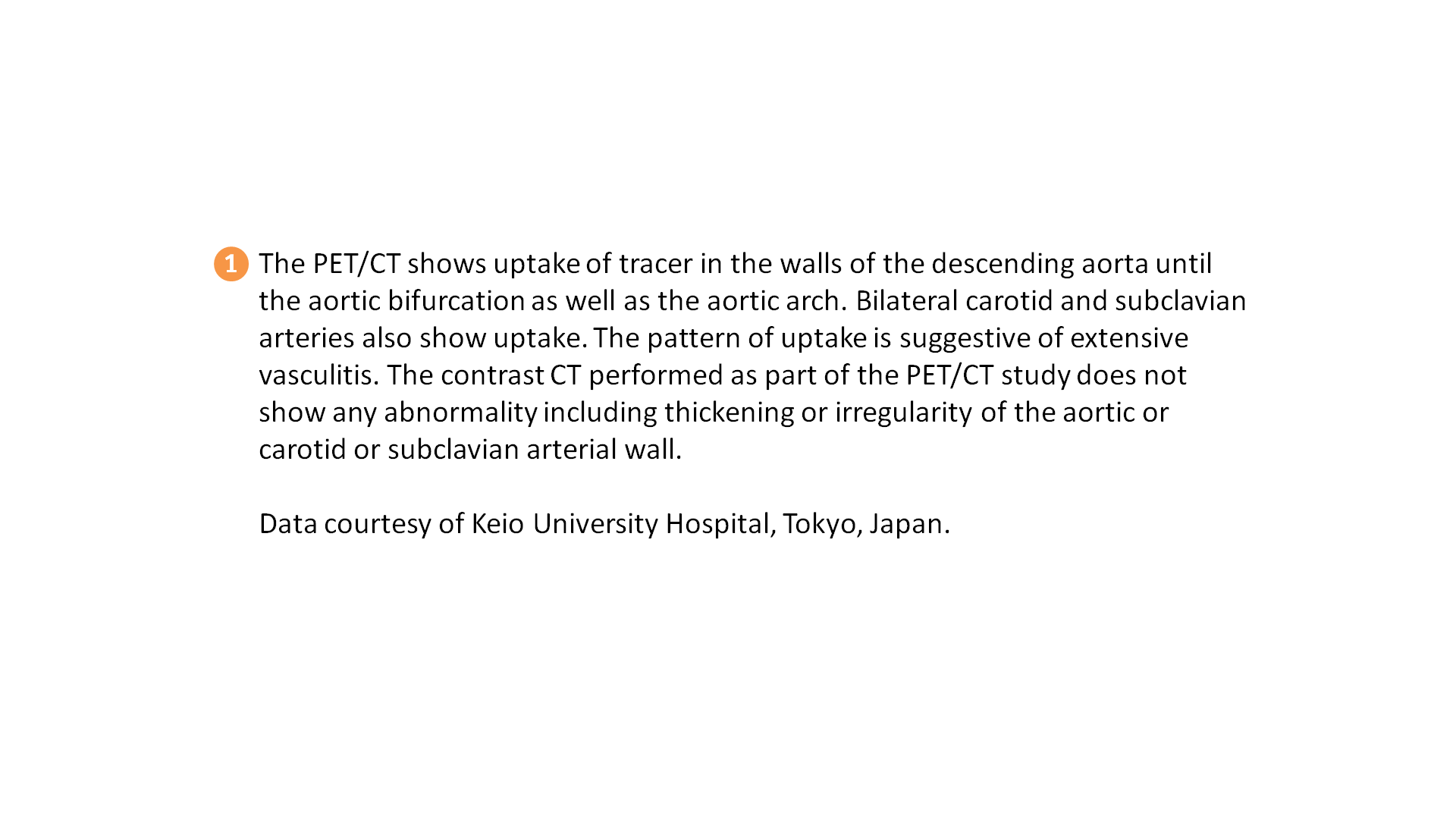 PET/CT Detection Of Temporal Arteritis