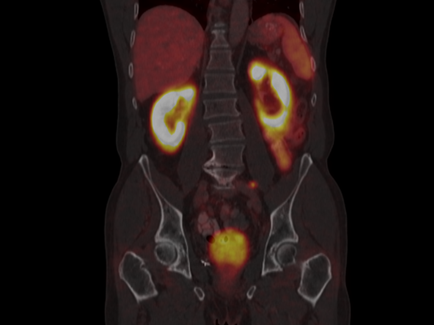 The Value of Molecular Imaging for Prostate Cancer