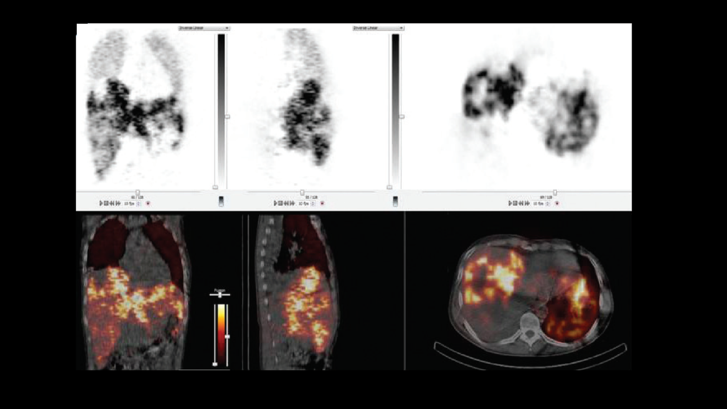 Quantitative SPECT imaging of hepato-pulmonary shunting prior to SIR ...