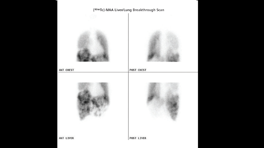 Quantitative SPECT imaging of hepato-pulmonary shunting prior to SIR ...