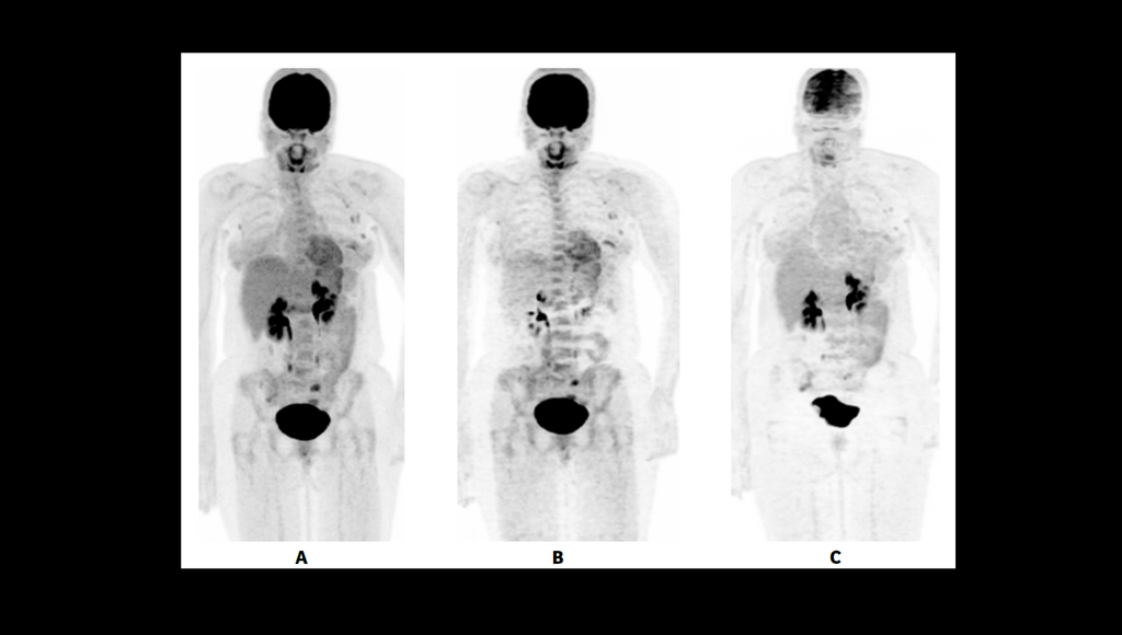 Whole-body parametric PET imaging in metastatic lung cancer