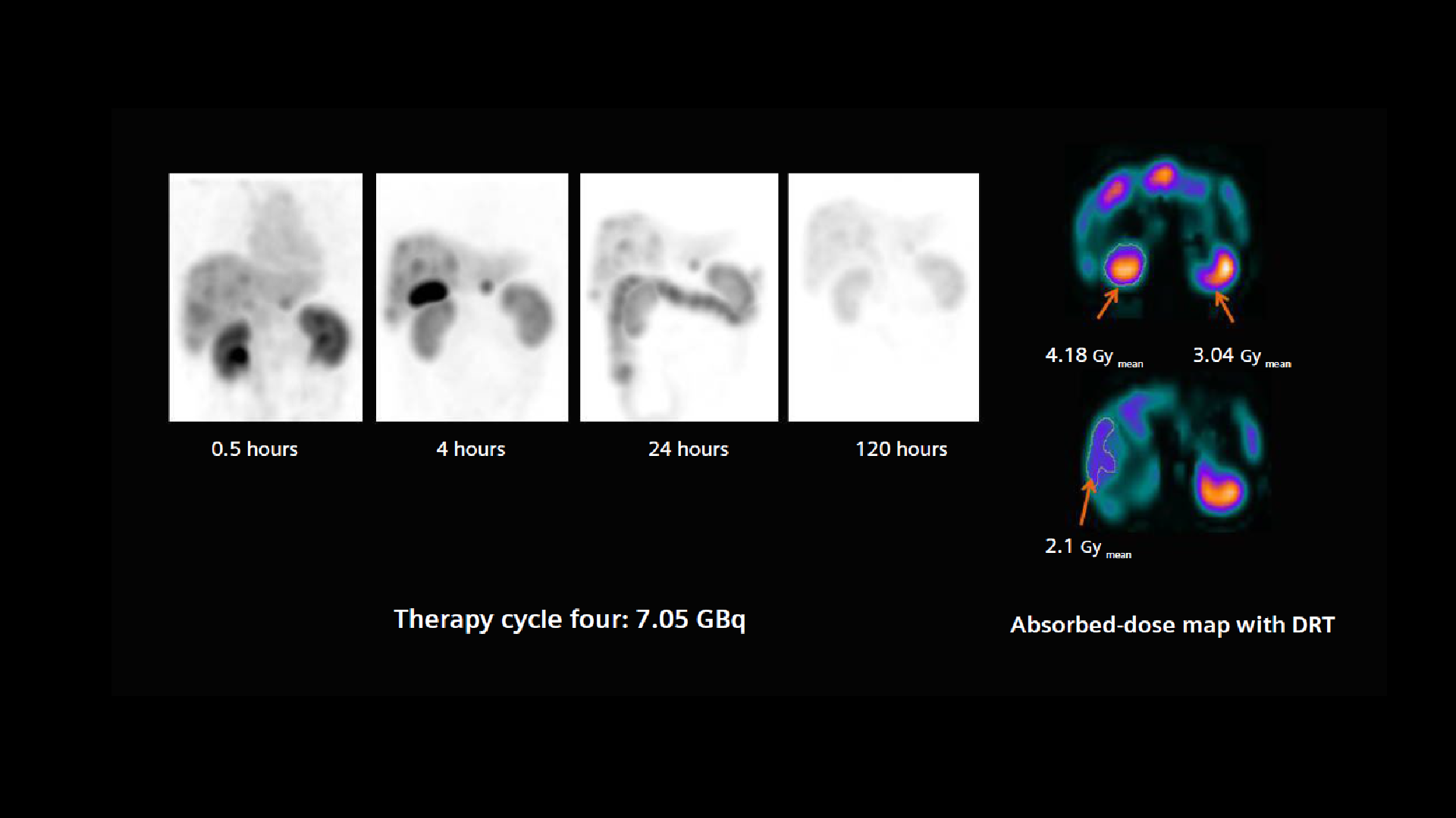 xSPECT Quant-based dosimetry over four 177Lu DOTATATE therapy cycles ...