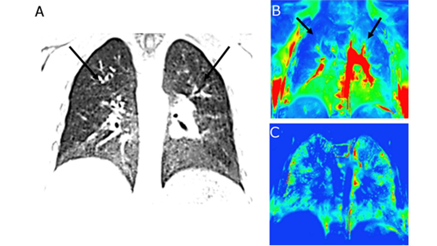 Lung MRI in Parenchymal Disease