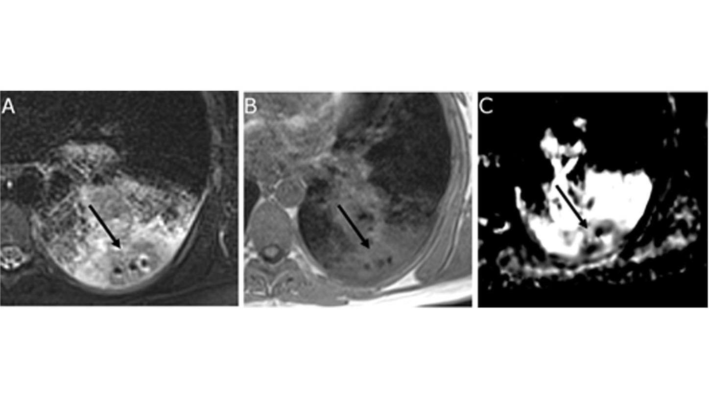 Lung MRI in Parenchymal Disease
