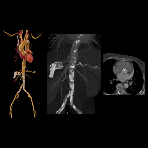 SOMATOM Definition Edge