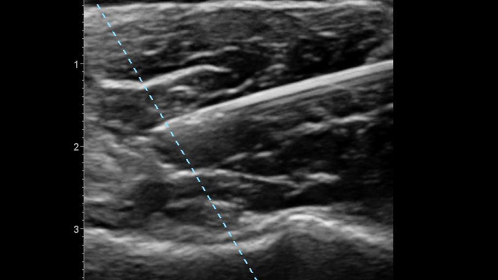 Wireless Ultrasound Transducers | ACUSON Freestyle