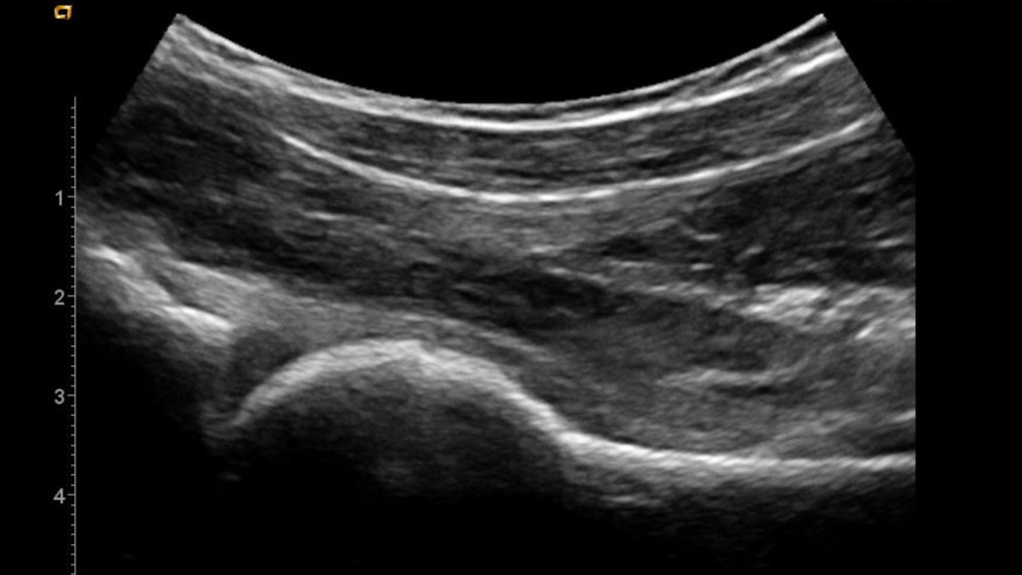 Wireless Ultrasound Transducers | ACUSON Freestyle