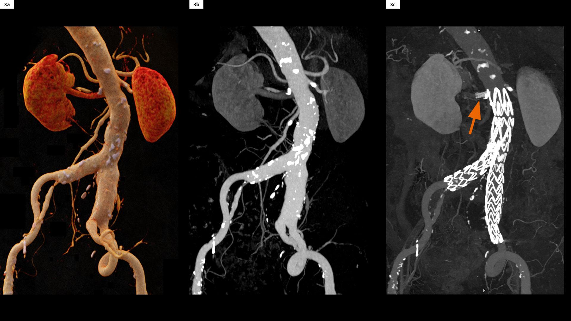 Isolated Common Iliac Artery Aneurysm – Complicated by Peripheral ...