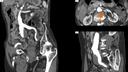Isolated Common Iliac Artery Aneurysm – Complicated by Peripheral ...