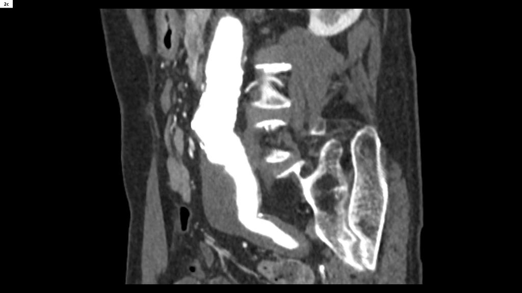 Isolated Common Iliac Artery Aneurysm – Complicated by Peripheral ...