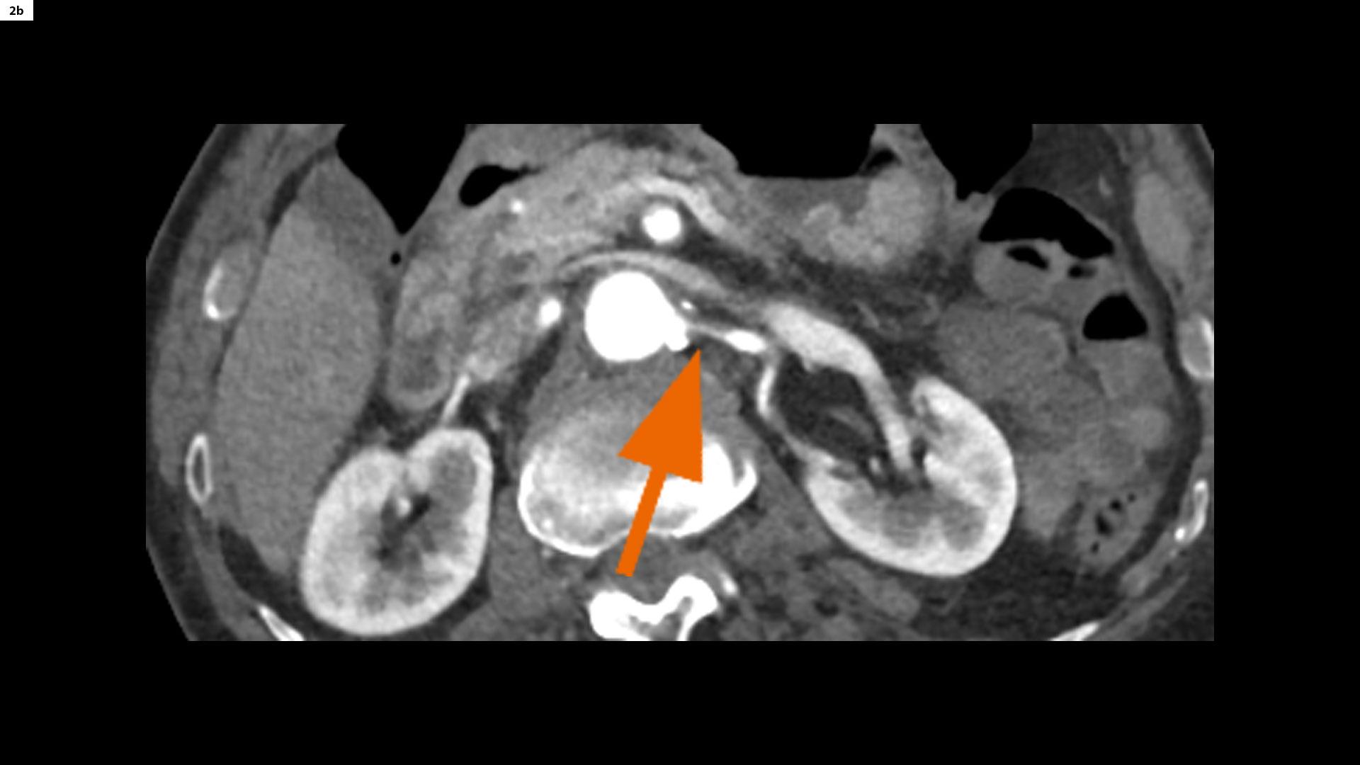 Isolated Common Iliac Artery Aneurysm – Complicated by Peripheral ...