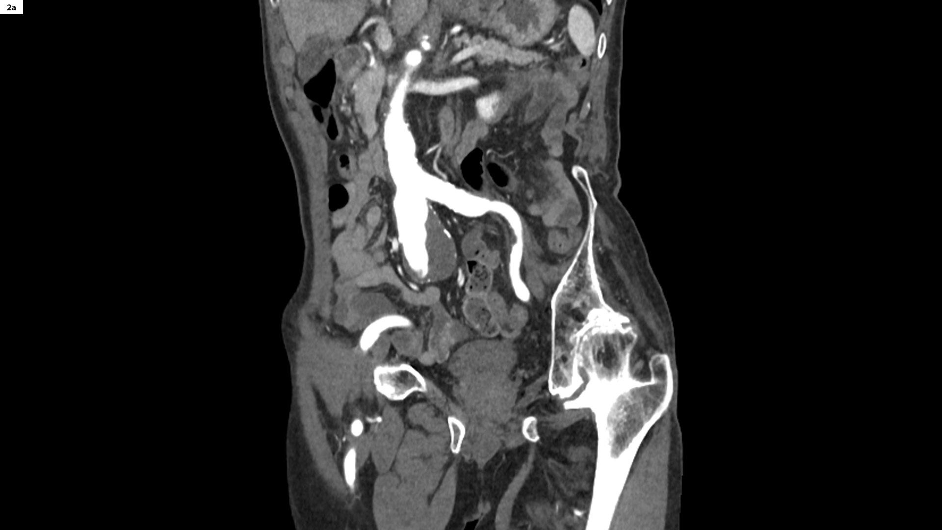 Isolated Common Iliac Artery Aneurysm – Complicated by Peripheral ...