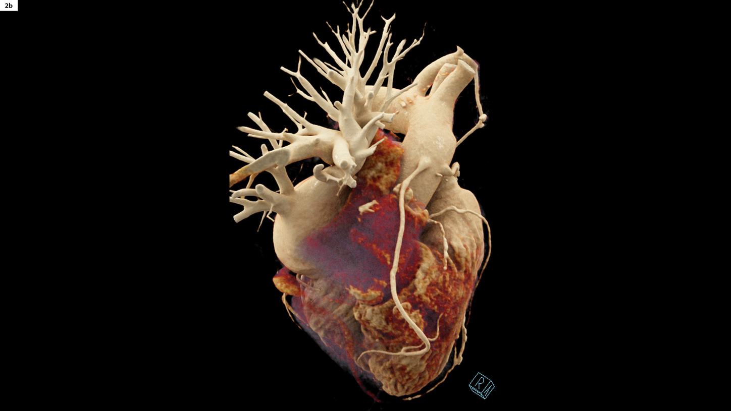 Sextuple Coronary Bypasses